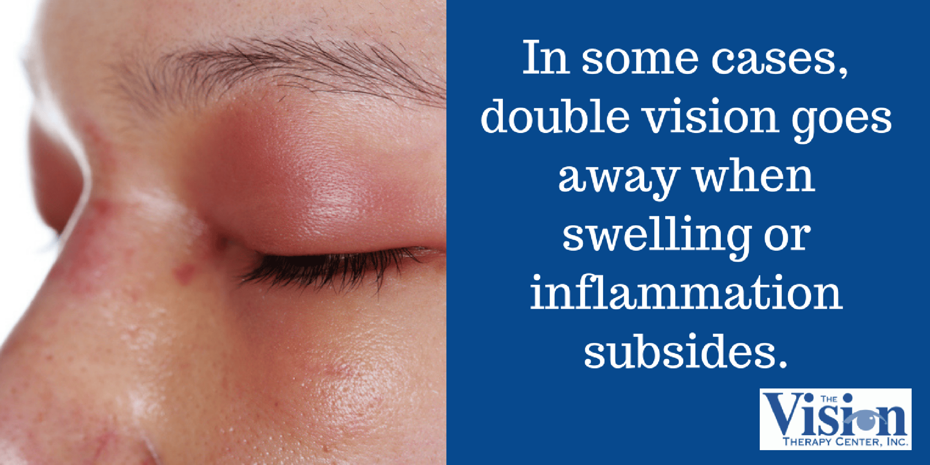 Double Vision After Concussions: When Your Eyes Can’t Work Together ...
