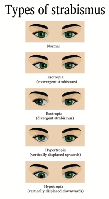 Strabismus | Crossed Eyes