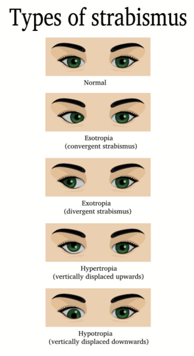 Strabismus | Crossed Eyes