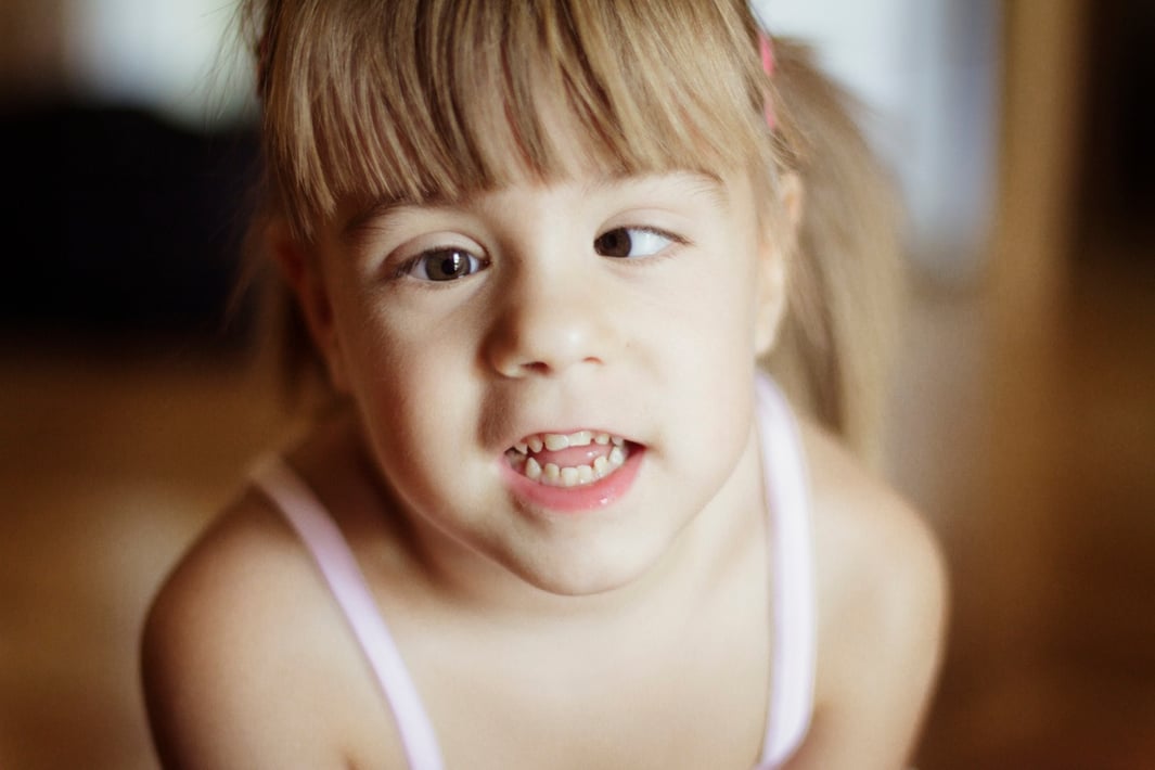 Strabismus | Crossed Eyes